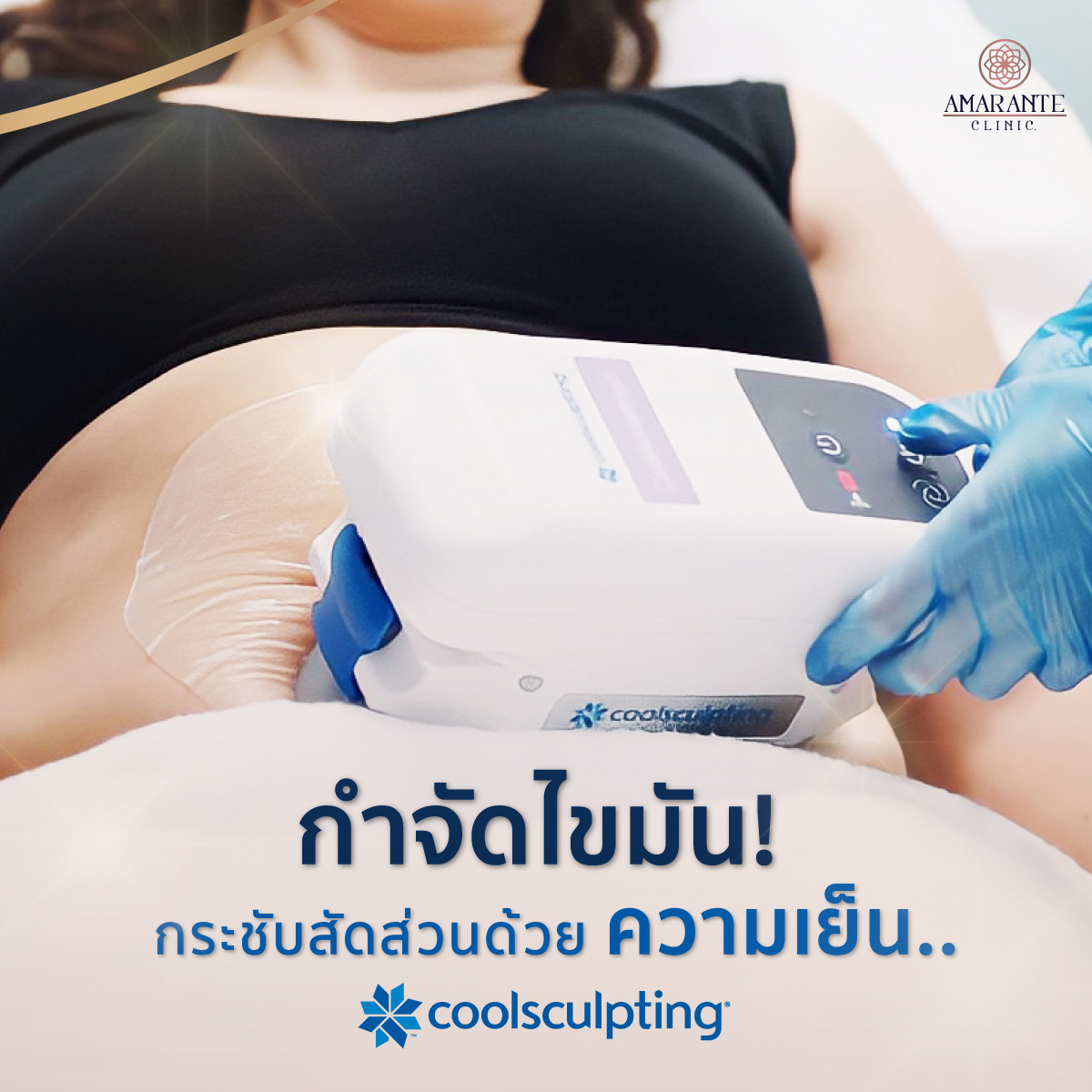 Cool Sculpting เทคโนโลยีและนวัตกรรม กระชับสัดส่วน สลายไขมันด้วยความเย็น