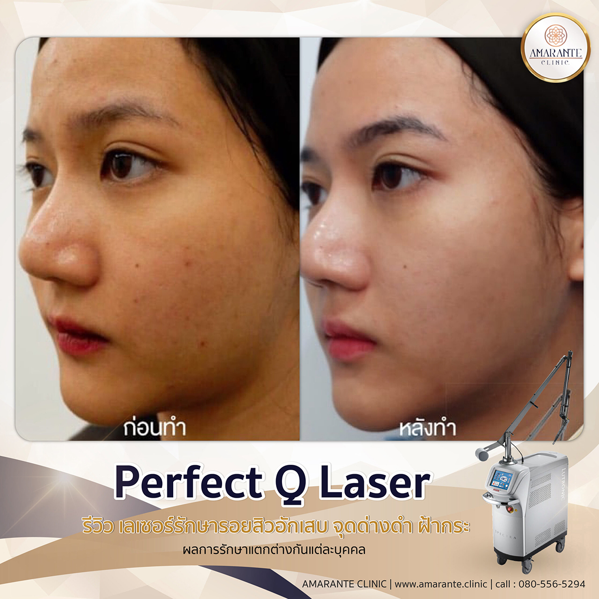 Perfect Q Laser เลเซอร์รอยสิว