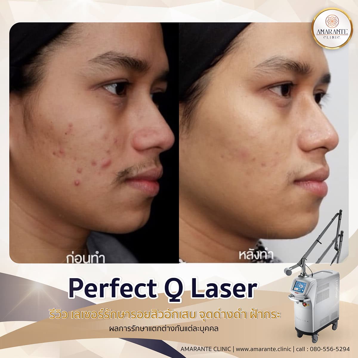 Perfect Q Laser เลเซอร์รอยสิว