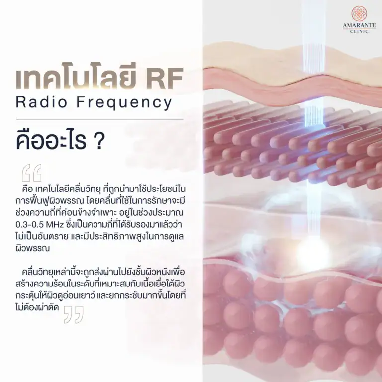 การทำ RF (Radio-Frequency) ยกกระชับผิวหน้า คืออะไร?